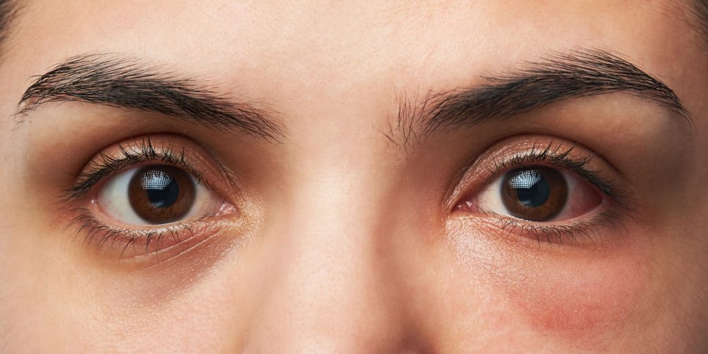 Understanding what causes red eye